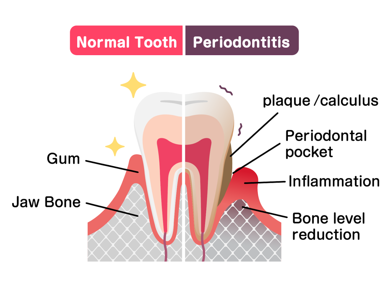 Periodontal Disease Stages, Symptoms, and What To Expect