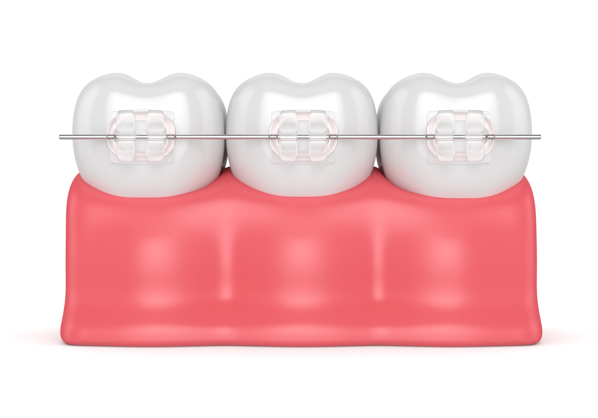 Types of Dental Braces - Lansdowne, VA Family Dentistry