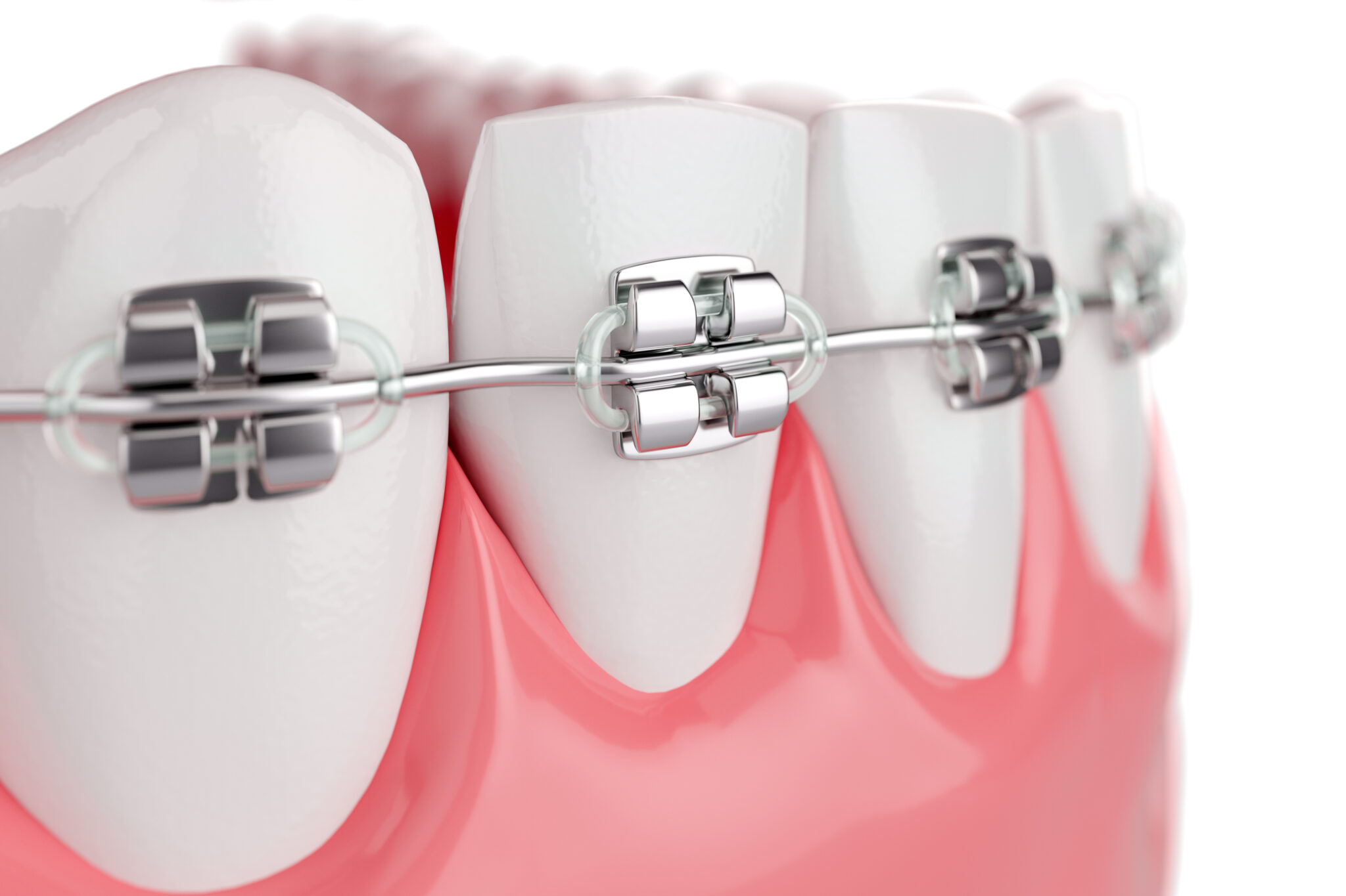 Types of Dental Braces - Lansdowne, VA Family Dentistry