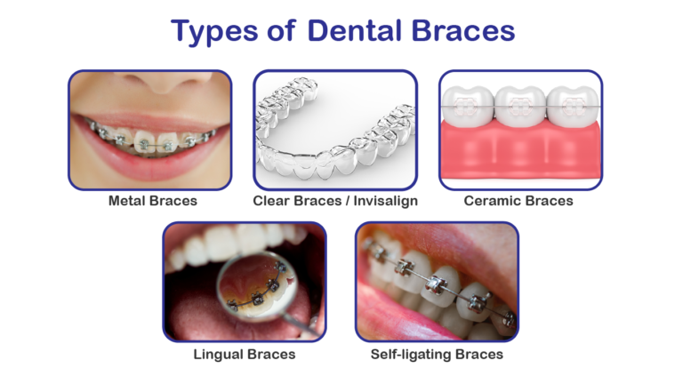 Types-of-braces - Lansdowne, VA Family Dentistry