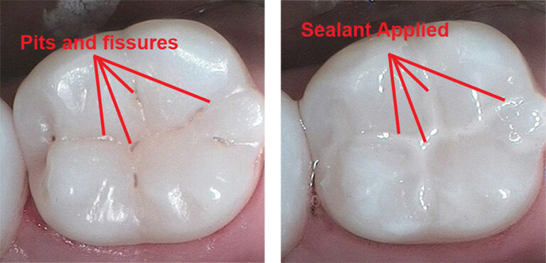 Pit and Fissure Sealants (Tooth Protective Coating): A Comprehensive ...