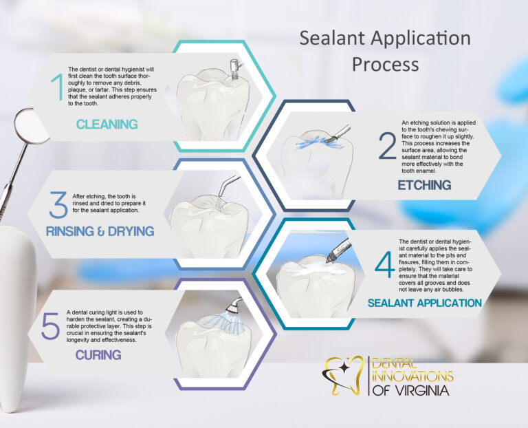 Pit and Fissure Sealants (Tooth Protective Coating): A Comprehensive ...