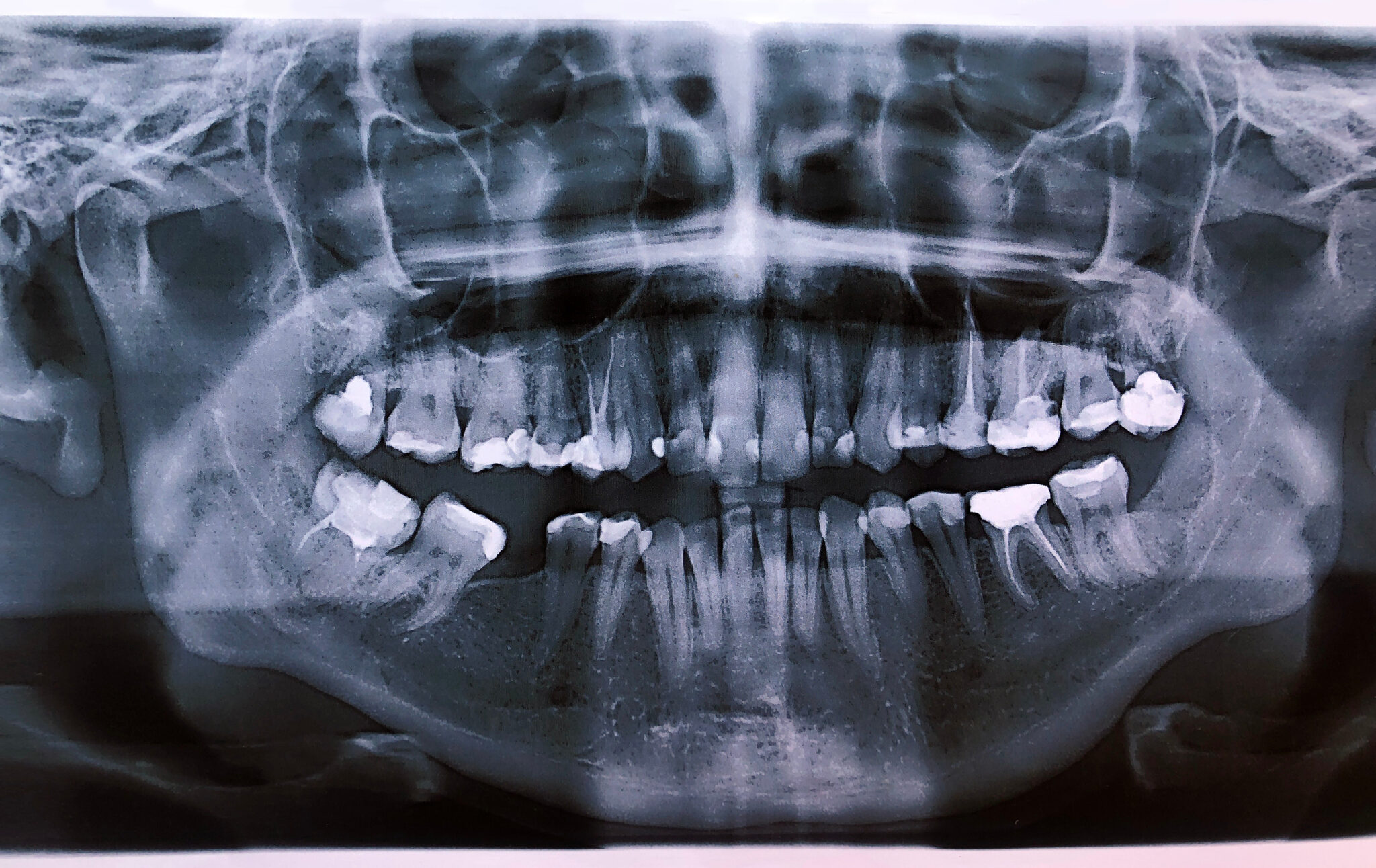 Understanding Dental Radiographs (X-rays): Safety and Benefits ...